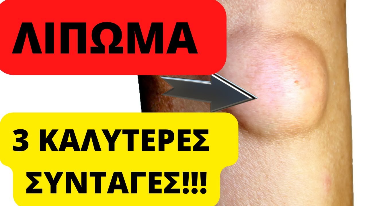 ΠΩΣ ΝΑ ΑΠΑΛΛΑΓΕΙΤΕ ΑΠΟ ΤΟ ΛΙΠΩΜΑ !!! - YouTube