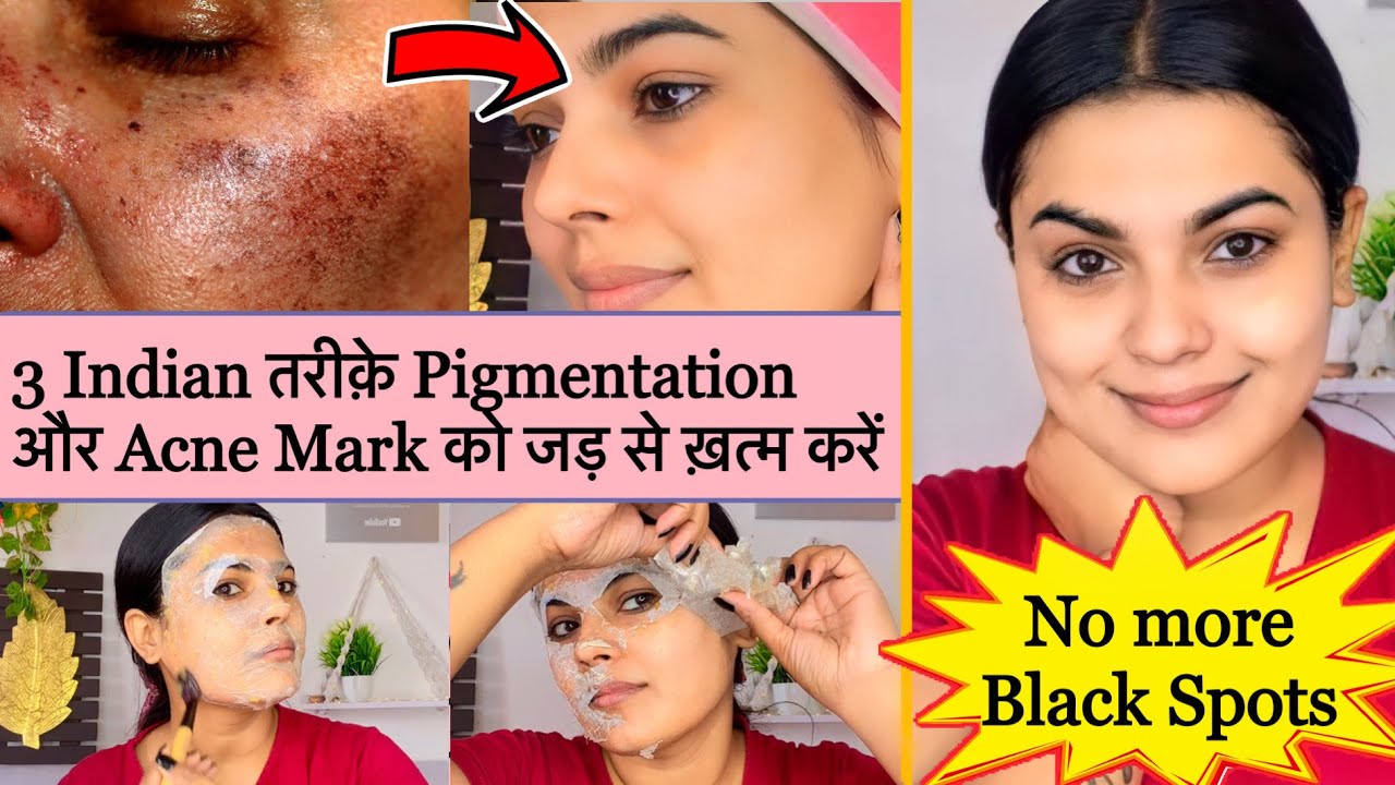 DIY | Remove ACNE MARKS, BLACK SPOTS & PIGMENTATION in just 2 Week ...