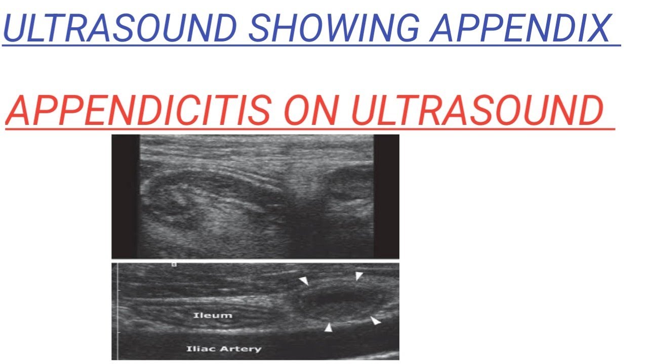 Appendicitis on ultrasound!Ultrasound showing inflammed Appendix ...