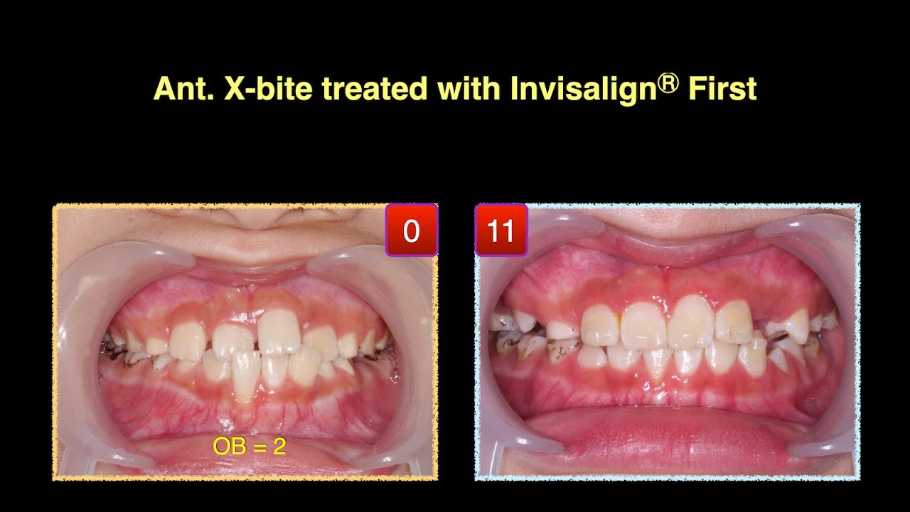 Anterior Crossbite treated with Invisalign First｜【Chris Chang Ortho ...