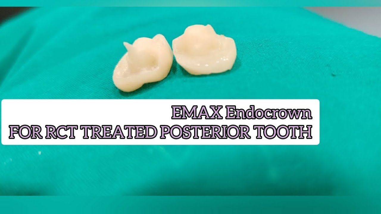 Emax Endocrown for posterior teeth after RCT- ENDOCROWN - YouTube