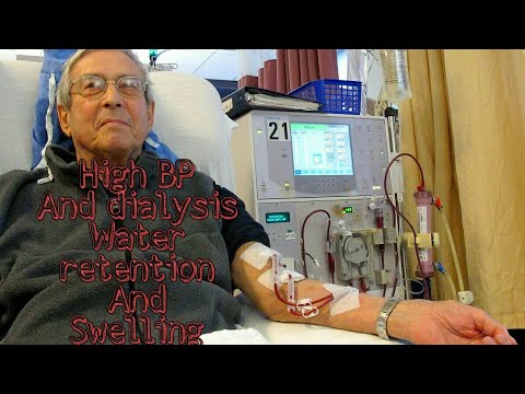 Best results of Oncoban on high BP, dialysis, water retention, and ...