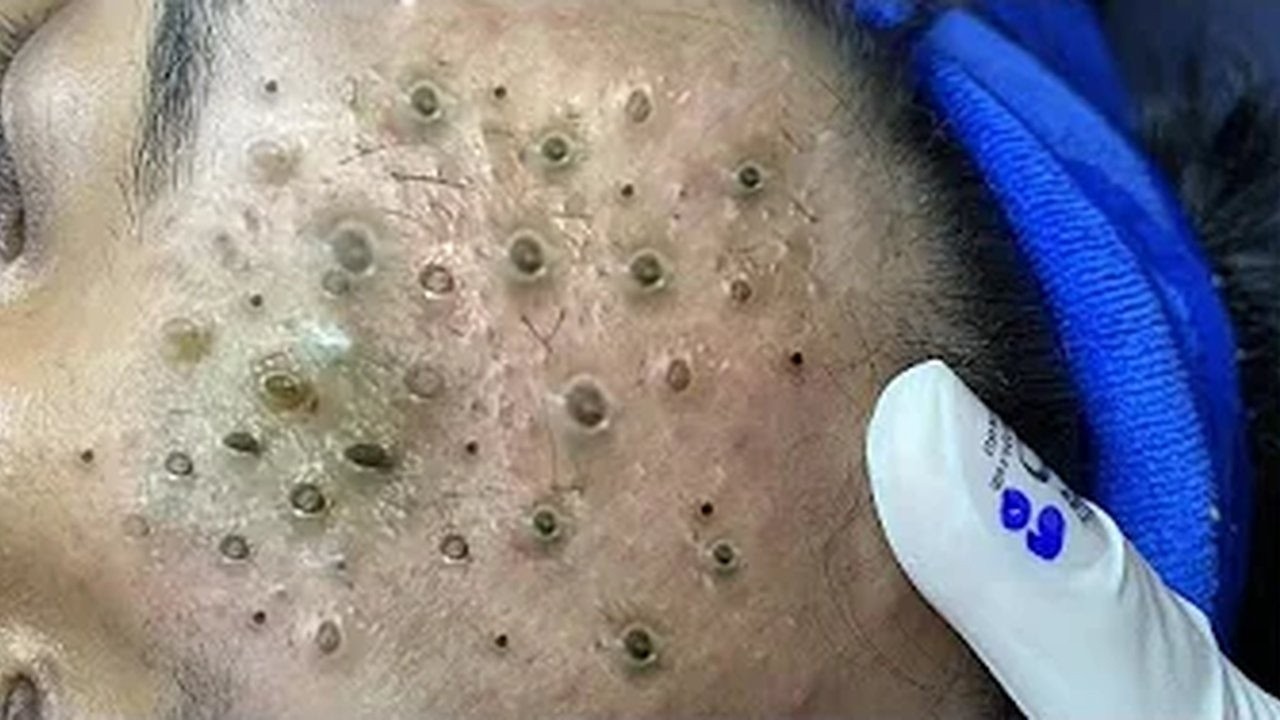 Giant Blackhead Extraction! Satisfying Pore Cleaning ASMR 😱🔥 - YouTube