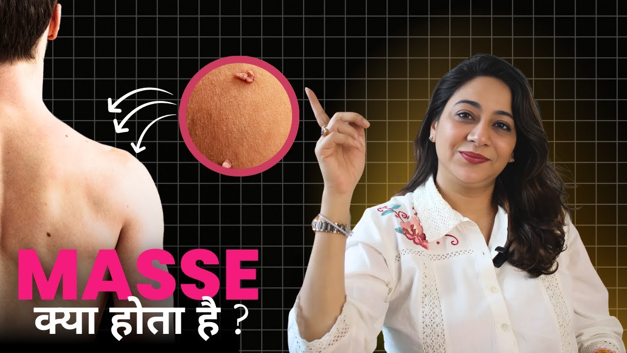 Skin Warts & Skin Tags: Causes, Removal & Prevention | Masse | Dr ...