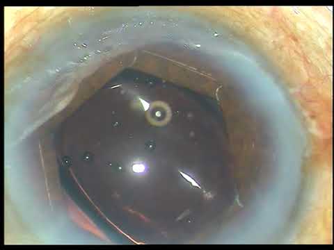Small Pupil Phaco using B-HEX pupil expander - P M, 13th July, 2018 ...