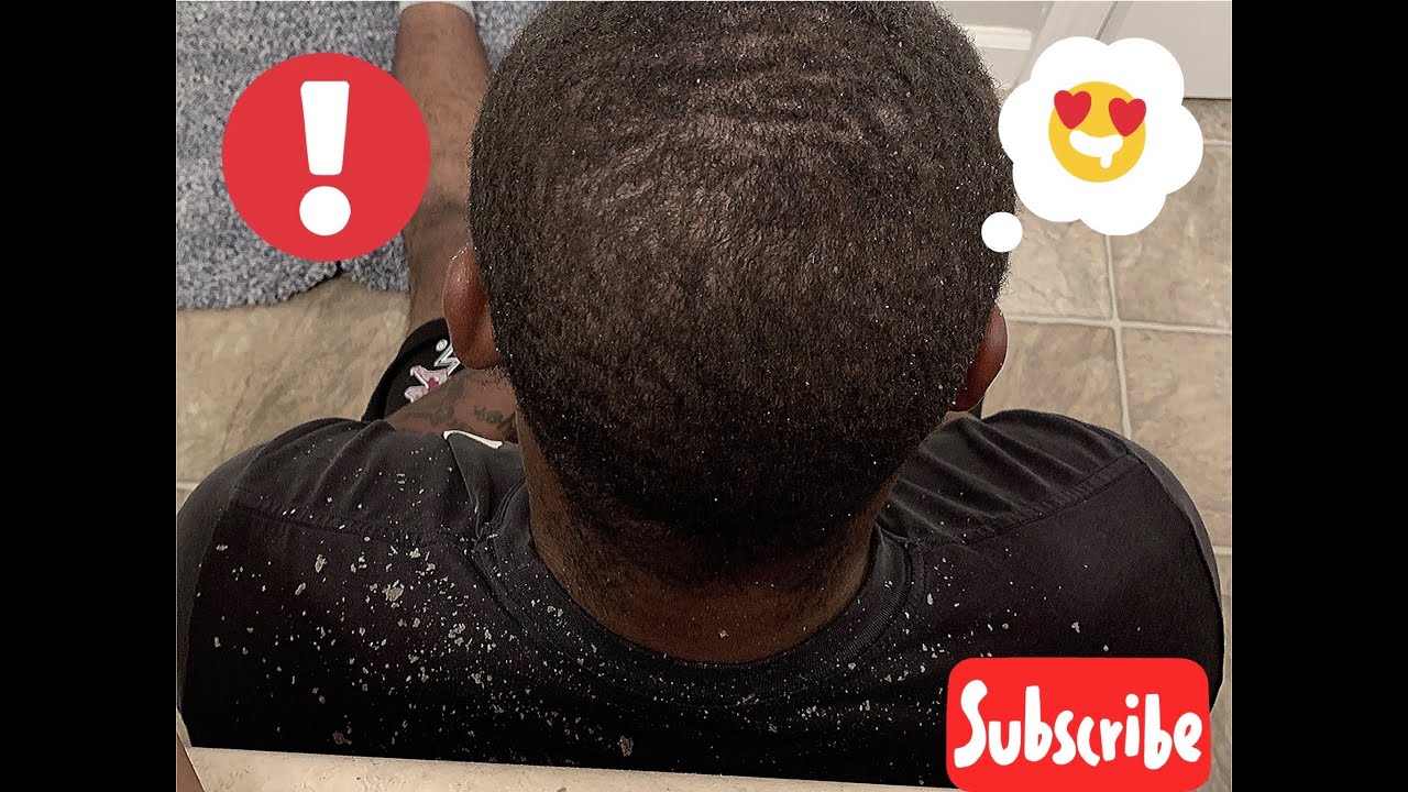 HUGE FLAKES *up close* Dandruff scalp scratching | Satisfying Dandruff ...