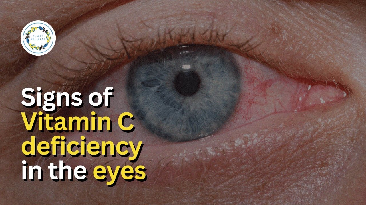Signs of Vitamin C deficiency in the eyes - YouTube