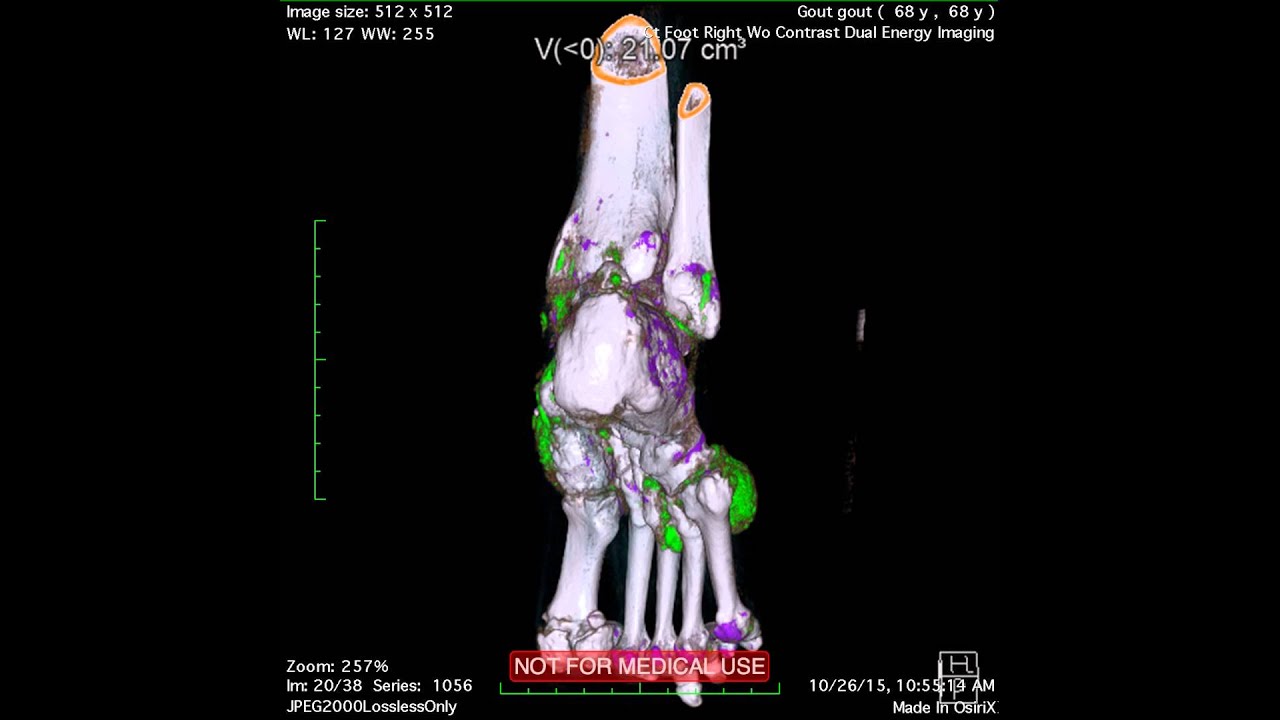 Foot Gout Dual Energy CT - YouTube