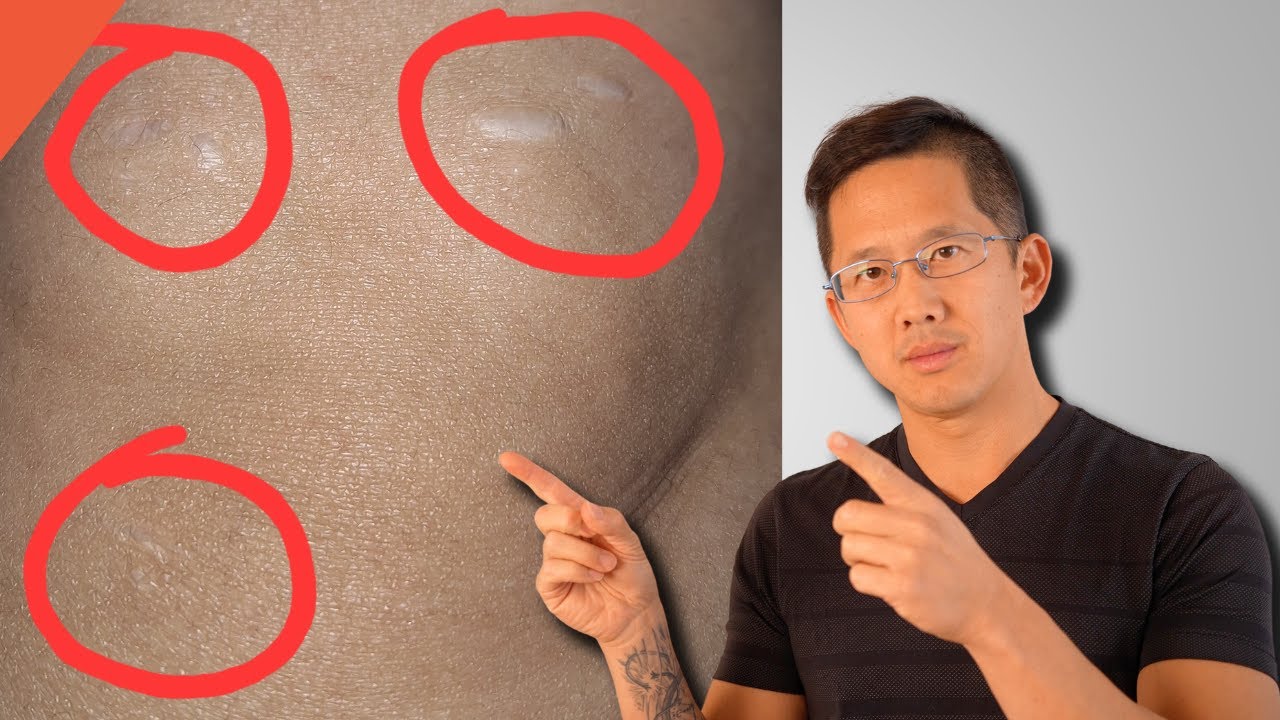 Multiple Knee Surgeries and Knee Pain in Her Forties - YouTube