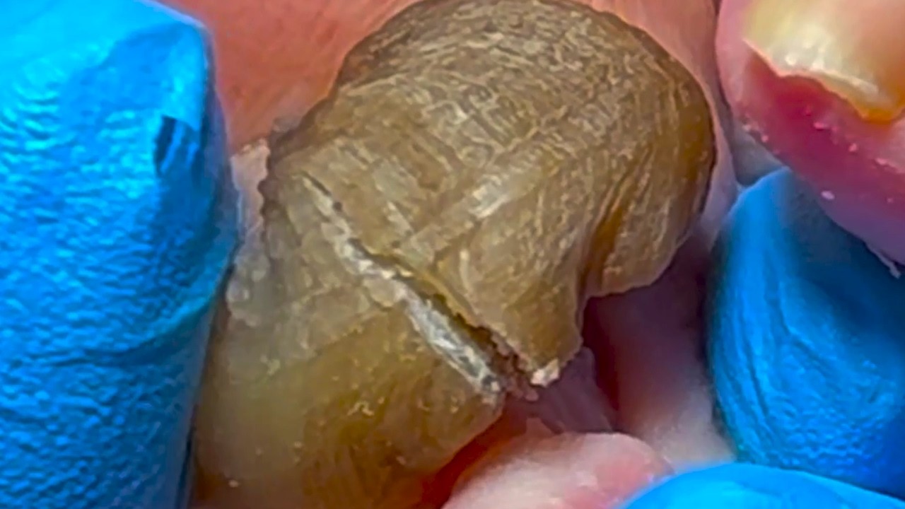 Just twist the curled toenails once and cut them off instantly ...