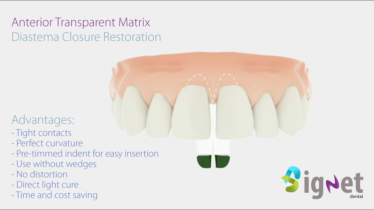 Diastema closure restoration with Signet transparent anterior matrix ...