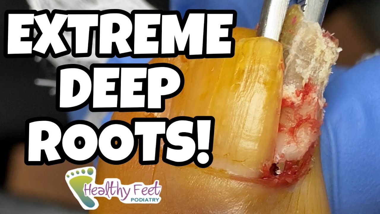 EXTREMELY SATISFYING REMOVAL OF A CHUNK OF TOENAIL WITH THE DEEPEST ...