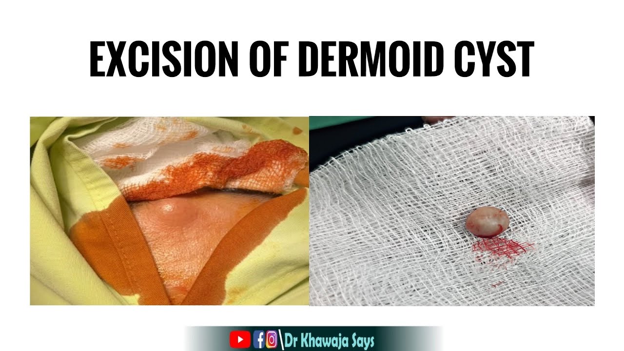 Excision of Dermoid Cyst/Excision and Biopsy/Dermoid cyst at Glabella ...