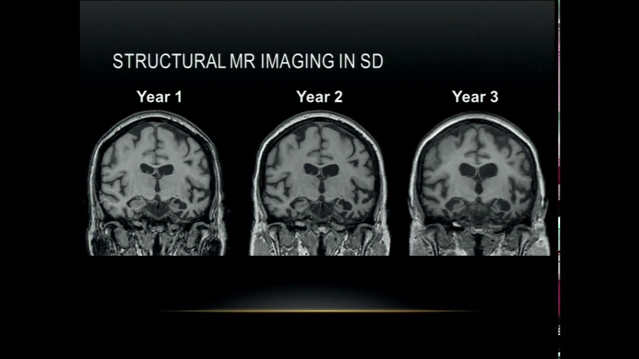 2015 FTD Annual Seminar: An overview of frontotemporal dementia - YouTube