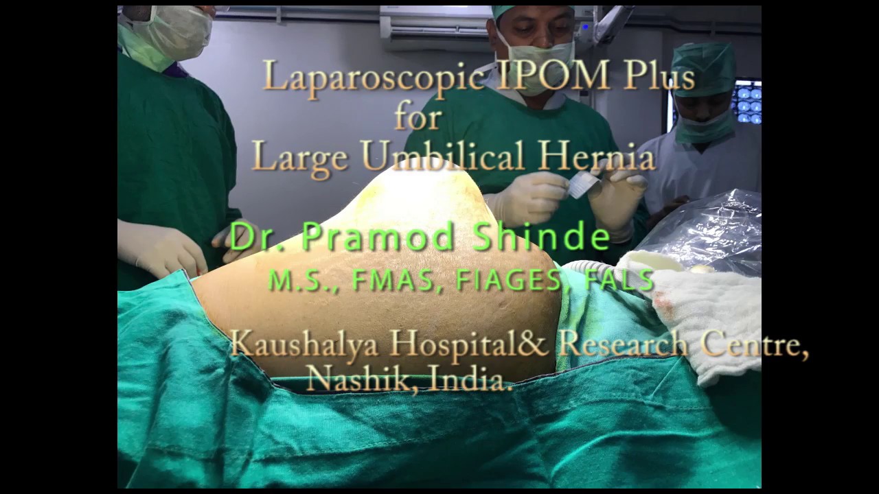 Laparoscopic Umbilical Hernia Repair IPOM Plus YouTube