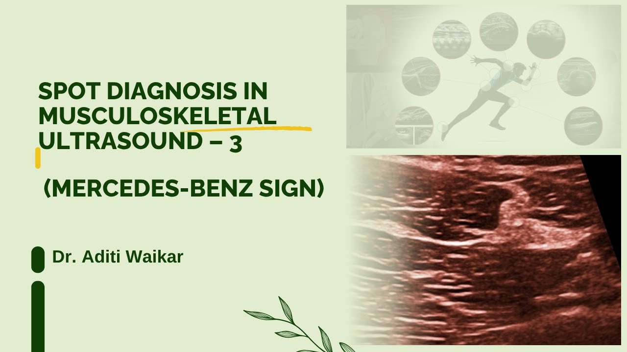Spot Diagnosis in Musculoskeletal Ultrasound - 3 (Mercedes - Benz Sign ...
