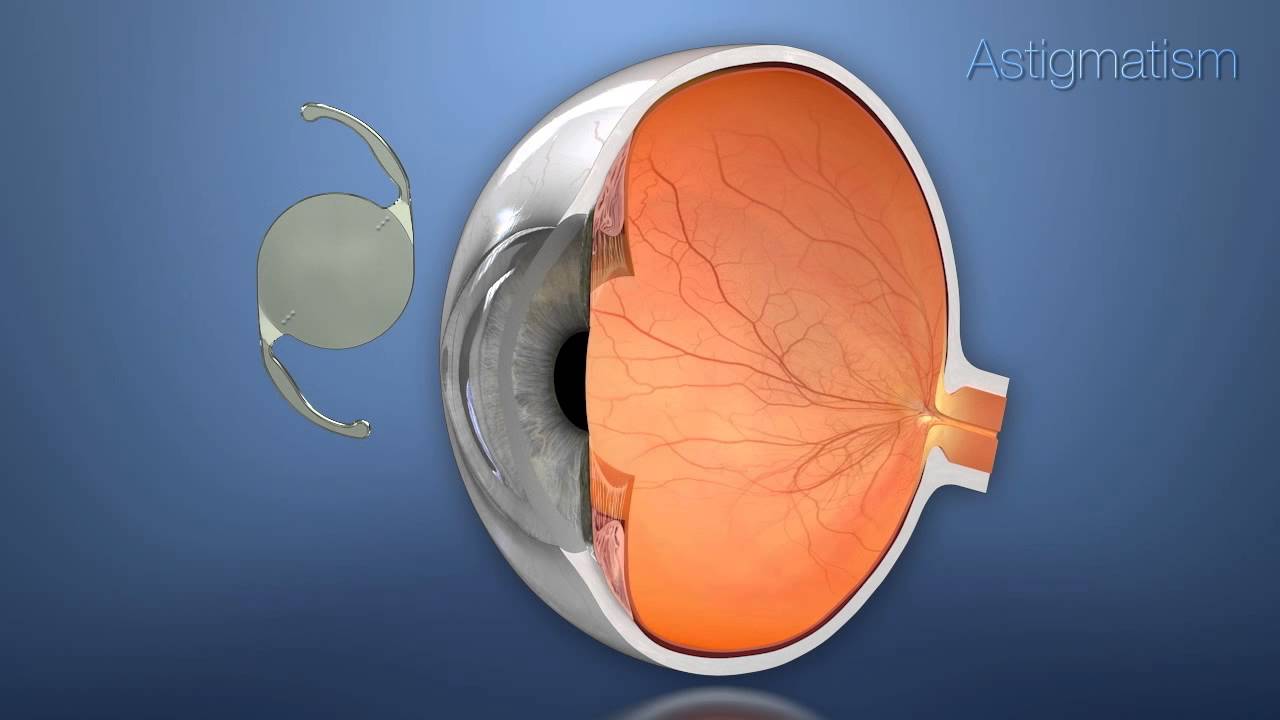 Toric IOL animation - YouTube