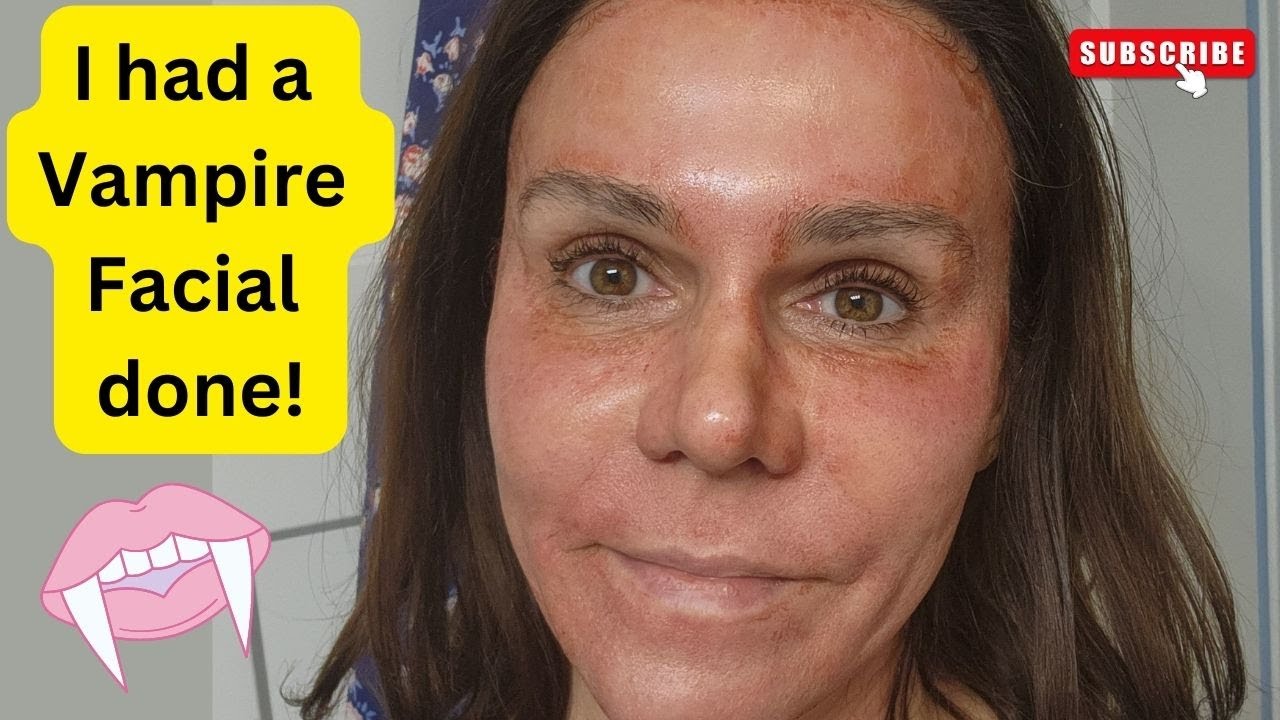 Vampire Facial Treatment for Anti-Aging - YouTube