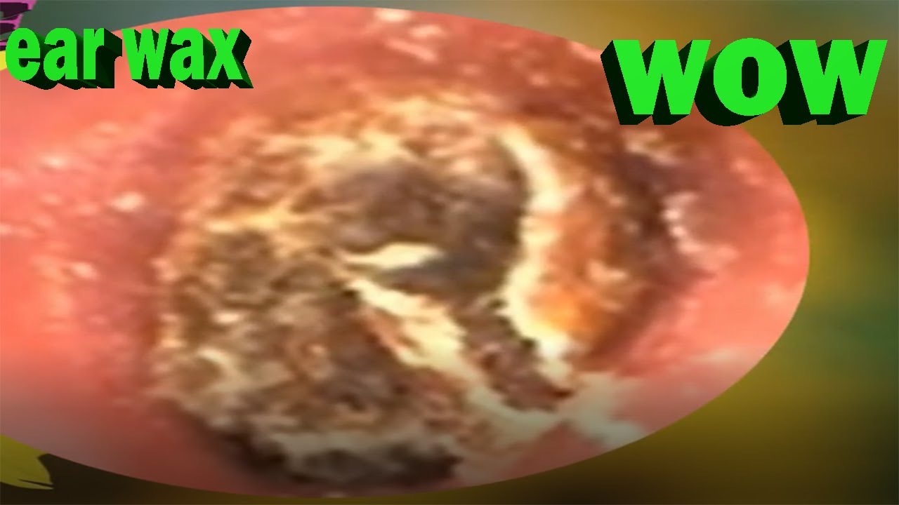 Huge Tonsil Stones Ear wax Removal in a case of Chronic Tonsillitis ...