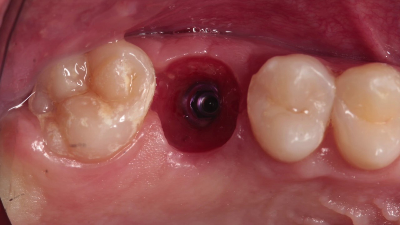 Complete Implant case from surgery to restoration - YouTube