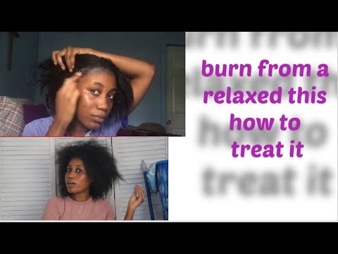 Badly burn from a relaxer |how to Treat relaxer burn on scalp ...