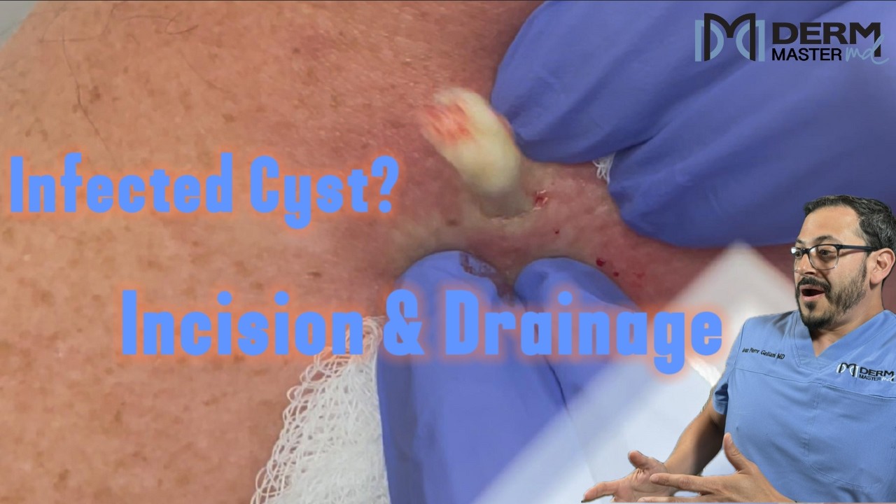 Infected cyst incision and drainage (For mobile- portrait mode) - YouTube
