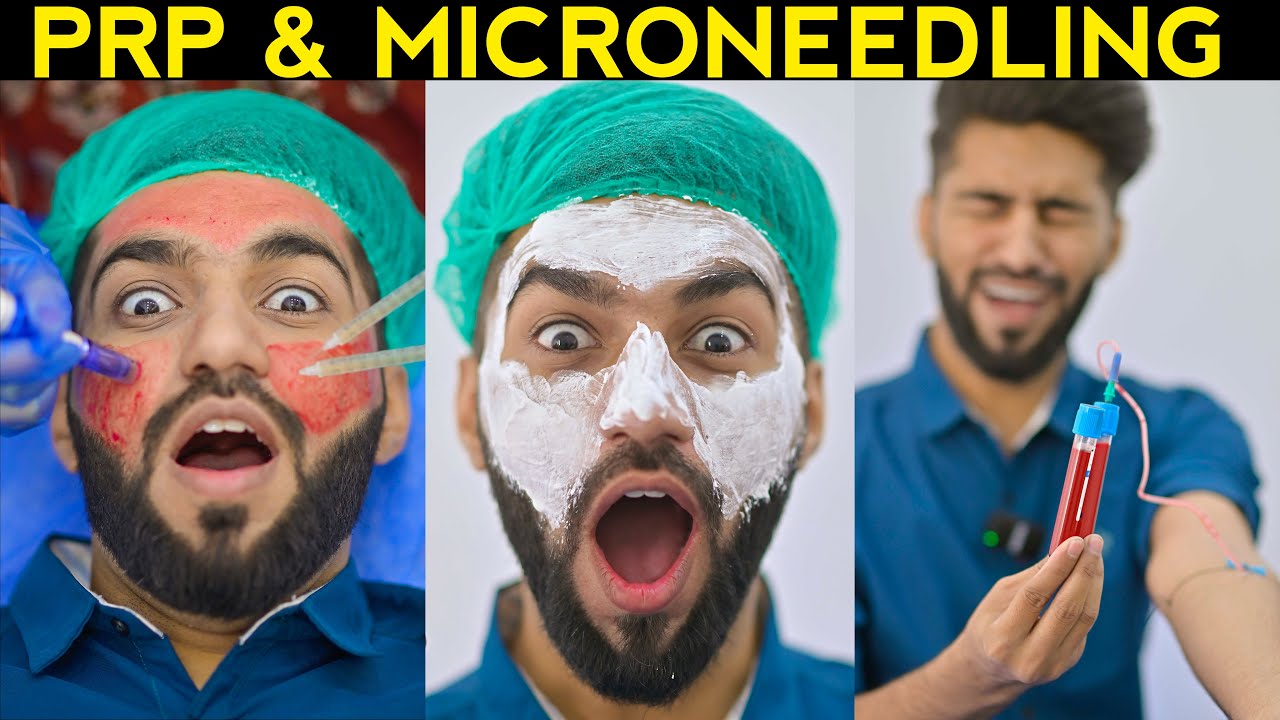 Prp Treatment with Microneedling for Acne,Scars,Pimples,blemish ...