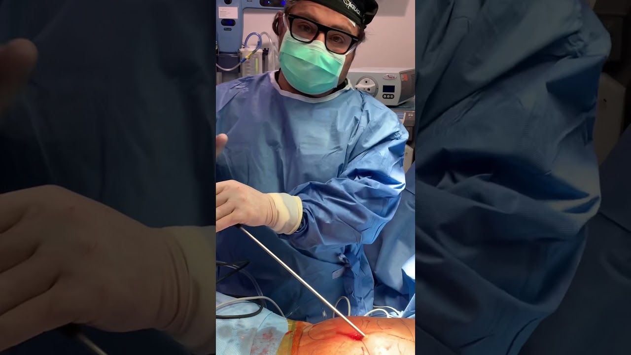 What is tumescent fluid? And why do we use it in plastic surgery ...