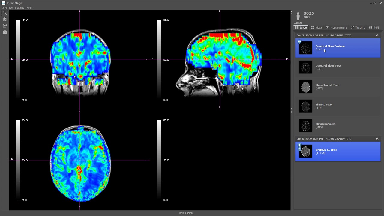 How to Process an MR Perfusion Study in BrainMagix - YouTube