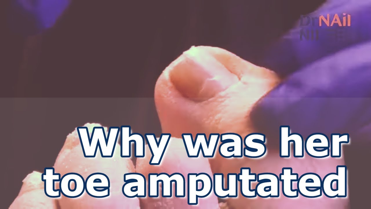Why was her toe amputated | FEET-ure Friday 👩🏻‍⚕️🦶👣 - YouTube