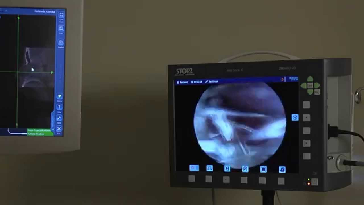 Balloon Sinuplasty General Anesthesia - YouTube