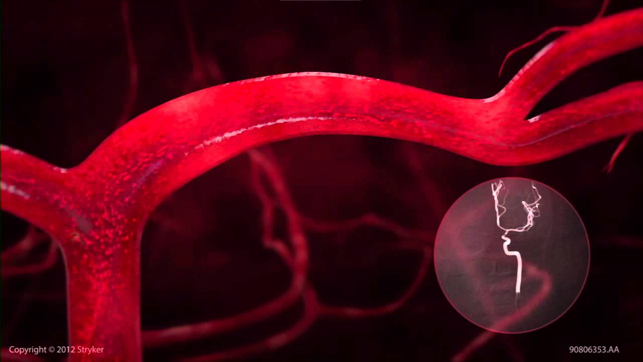 Stryker Neurovascular - YouTube