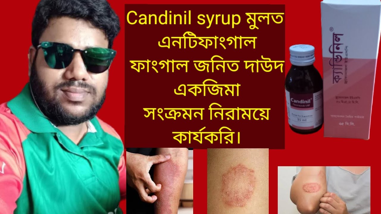 Candinil syrup মুলত এনটিফাংগাল ফাংগাল জনিত দাউদ একজিমা সংক্রমন নিরাময়ে ...