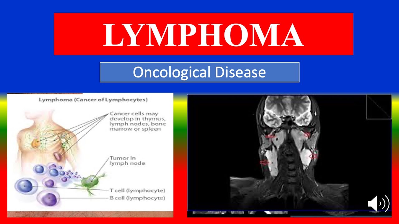 LYMPHOMA - Definition, types, causes, pathophysiology, signs & symptoms ...