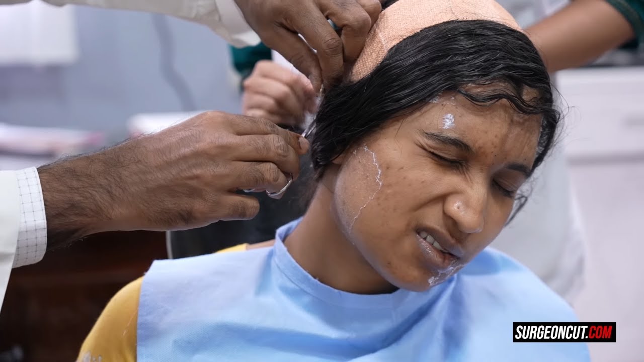 Craniofacial Deformity Correction Surgery - Removing Bandages from Head ...