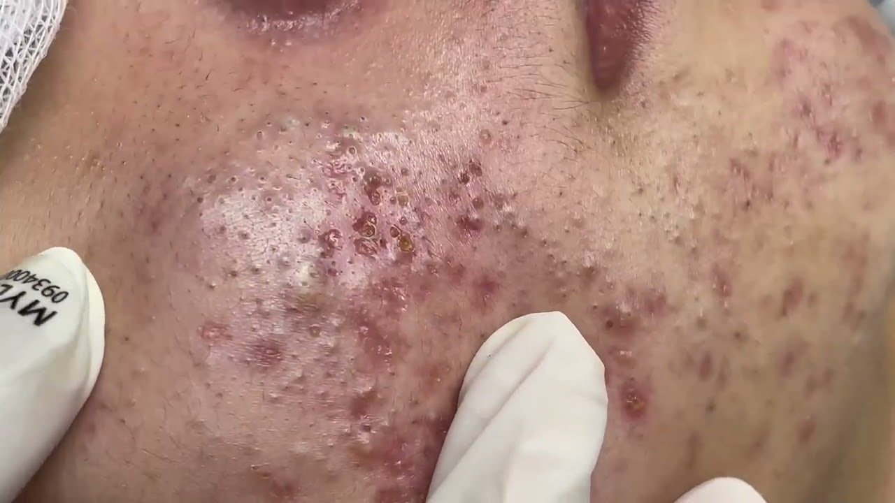 Mylinh . Most Satisfying Pimple Popping Ever #550 - YouTube