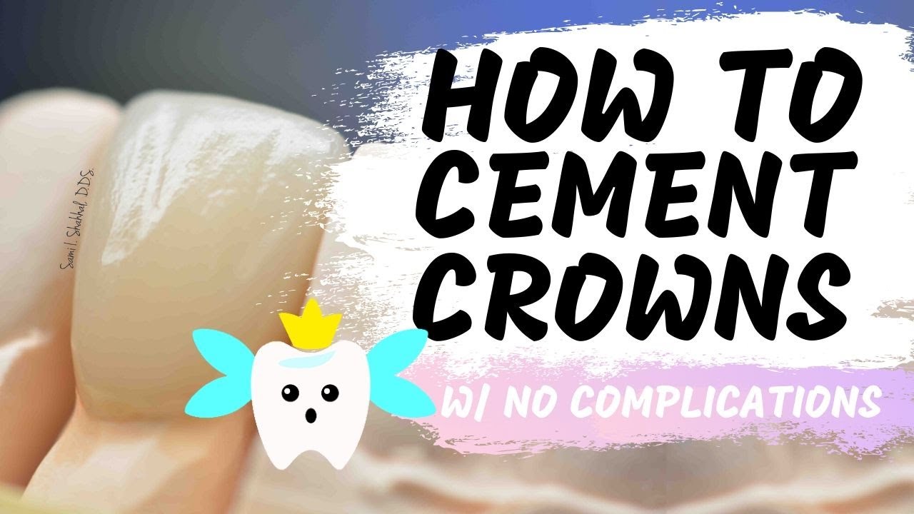 Dental Crown Delivery | 9 Tips to Make Your Crown Appointments Easier ...
