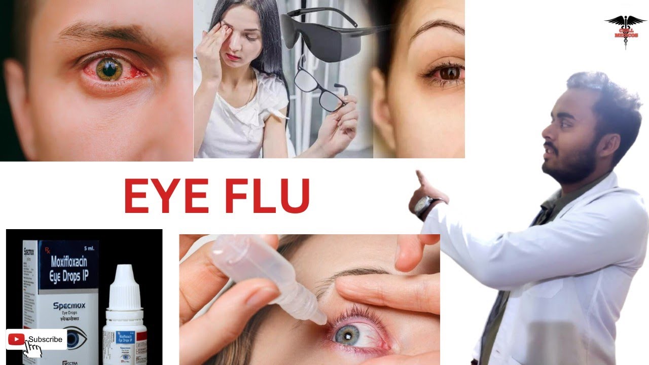 Eye Flu || आई फ्लू || Endemic Eye Flu in Hindi - YouTube
