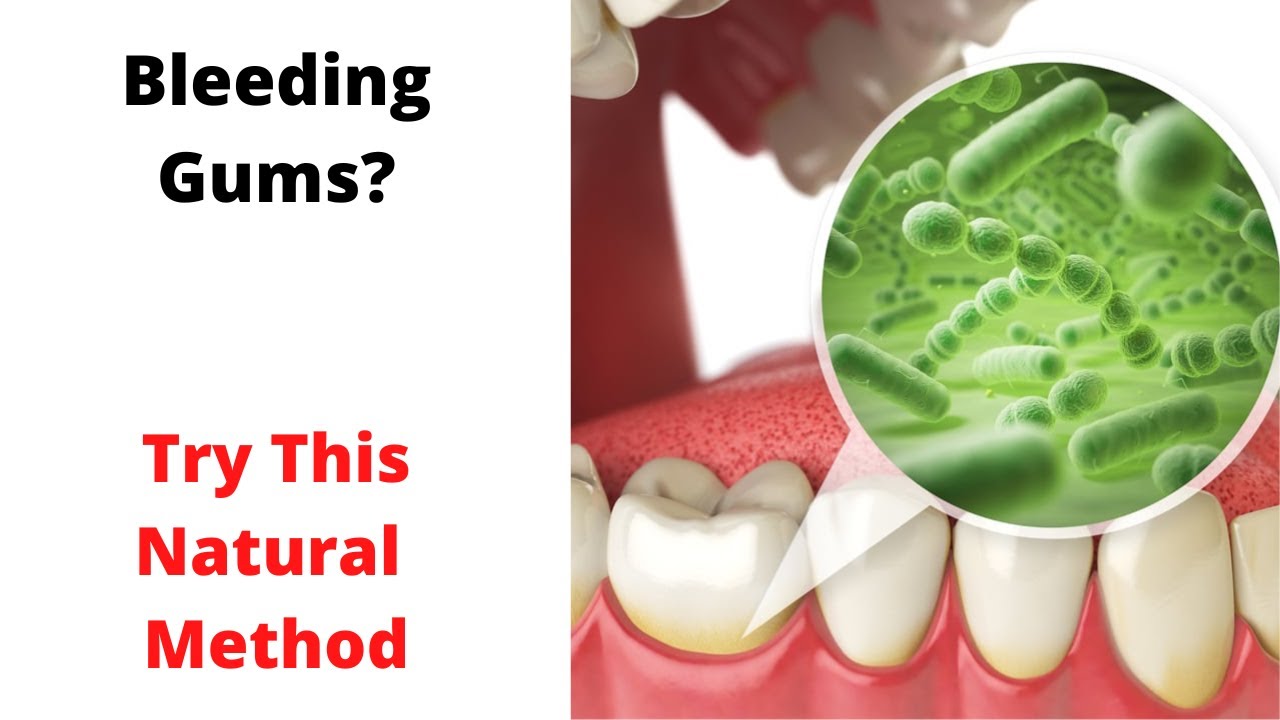 Natural Soft Mineral That Melts In Your Mouth To Rebuild Gums And Teeth ...