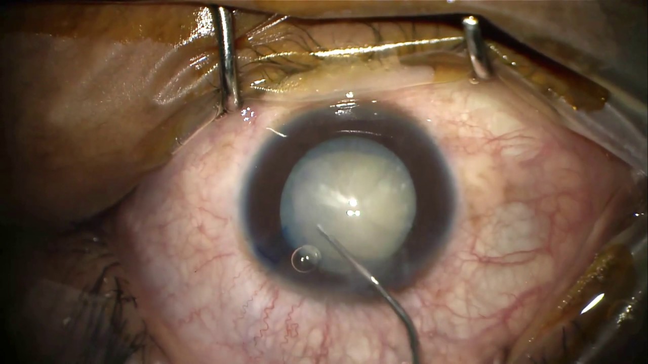 Catarata blanca //White Cataract Surgery - YouTube