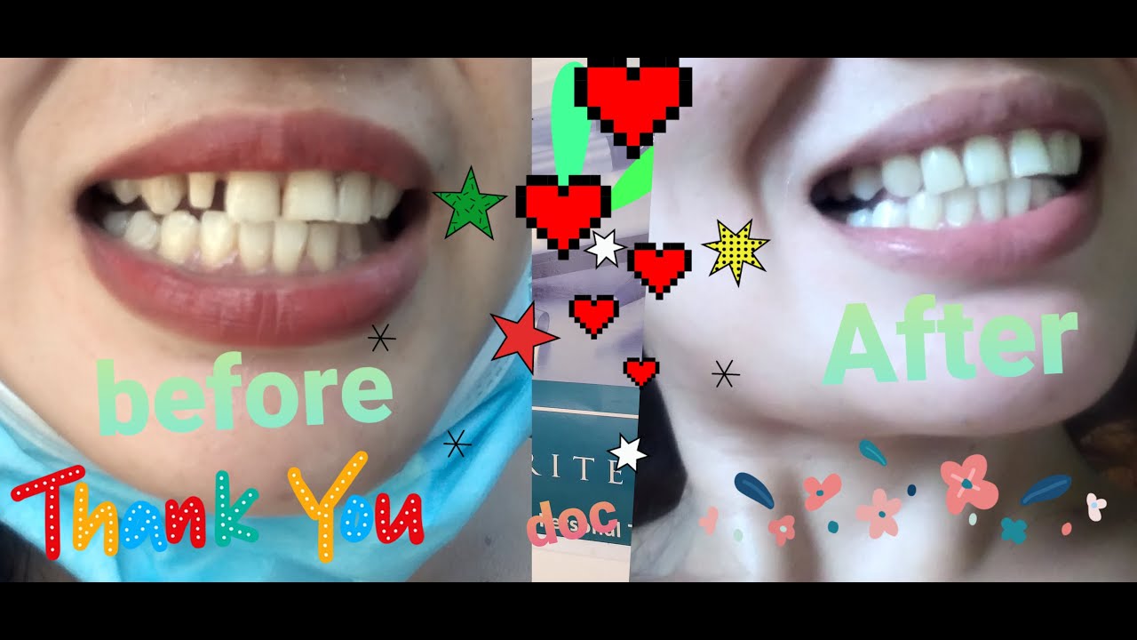 Dental Clinic Again for my Teeth Cleaning,Pasta,and Tooth Jacket Crown ...