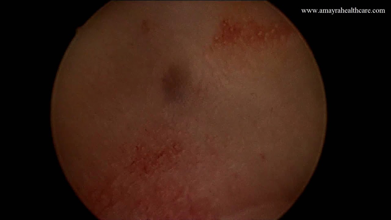 Septal resection by Dr Ajay Aggarwal - YouTube