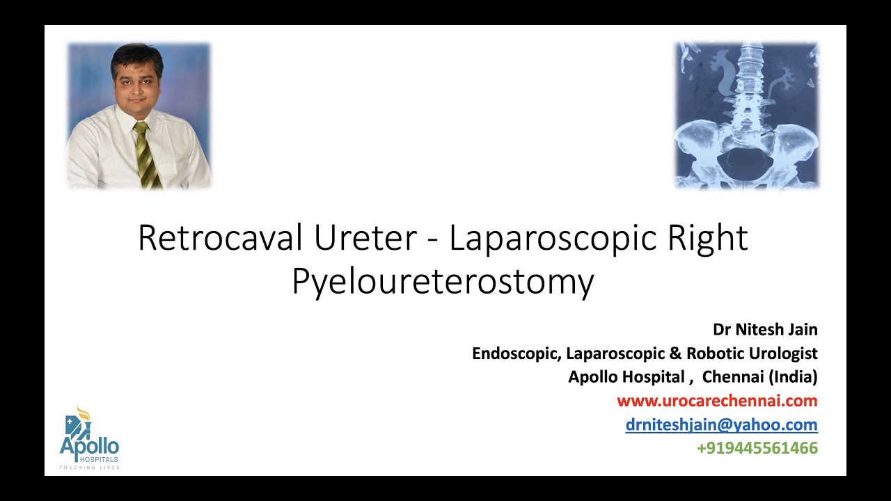 Laparoscopy Pyeloureterostomy for Retrocaval Ureter by Dr Nitesh Jain ...