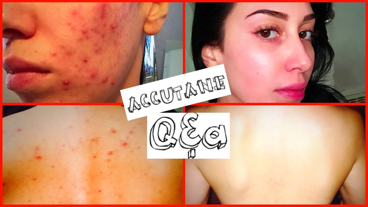 Post Accutane Most Asked Q&A | Dosage, Skincare, Cost, Depression - YouTube