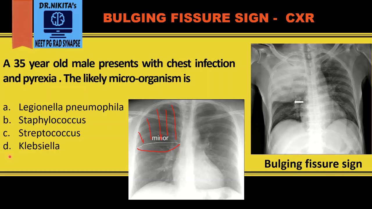 Bulging Fissure Sign The Radiology Assistant : Chest X Ray Lung