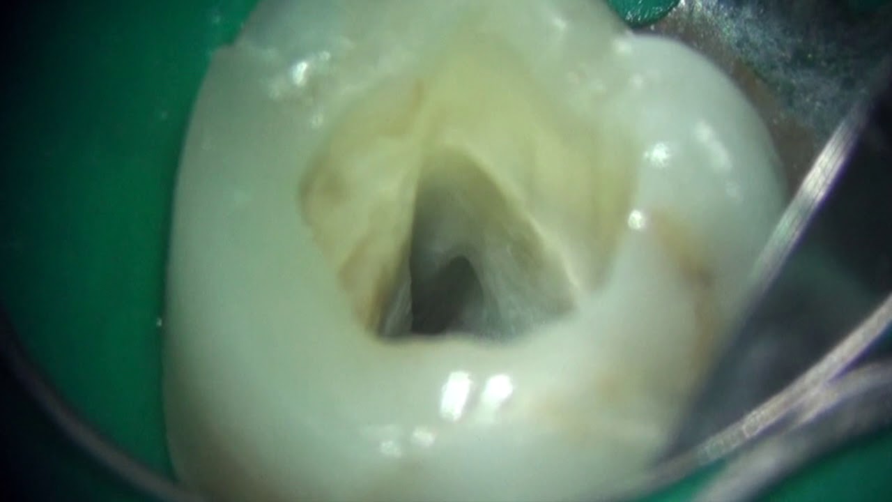 UR6 with three MB canals - YouTube