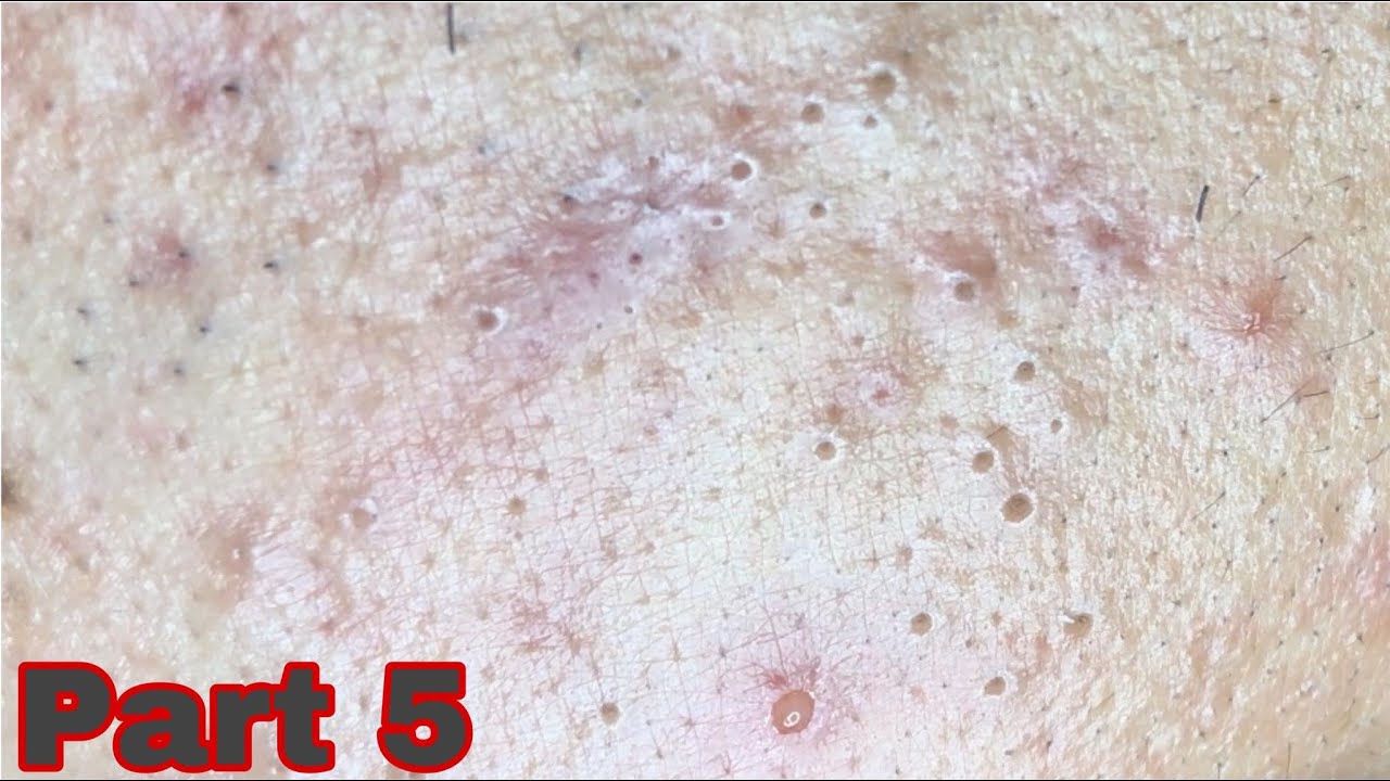 #5 blackheads .. customers have the most acne | B'Young Spa | nặn mụn đầu đen siêu nhiều - YouTube