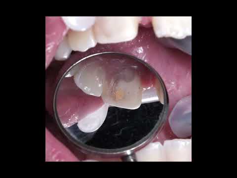 Enamel dentin pulp complicated crown fracture - YouTube