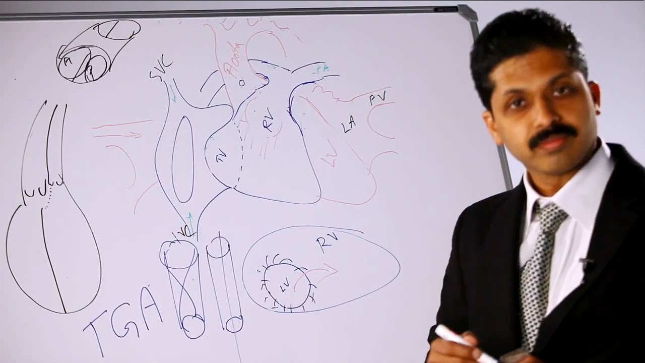 TGA - Transposition of the Great Arteries & ASO - Arterial Switch ...