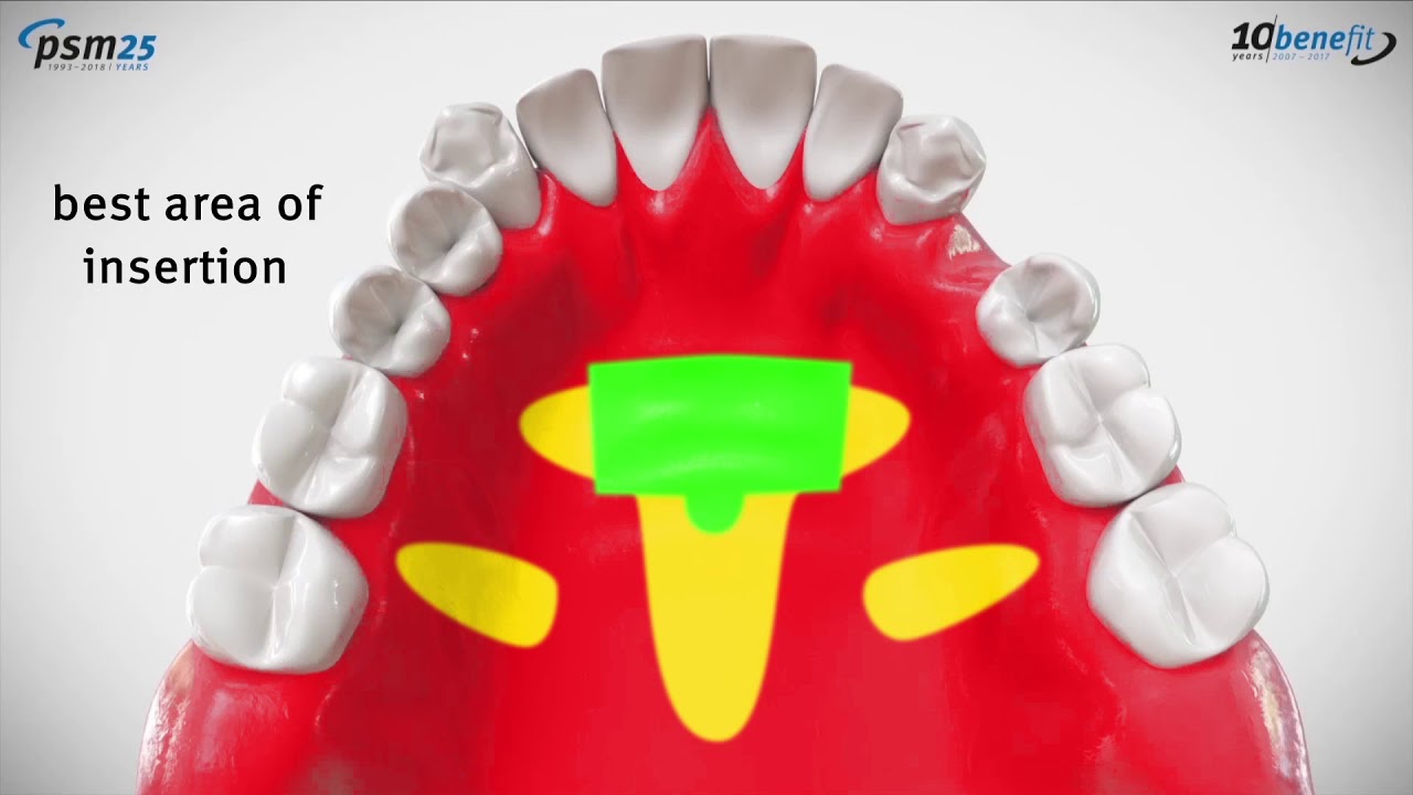 PSM ORGINAL BENEfit TAD Beneslider mesial/distal_09-2019 - YouTube